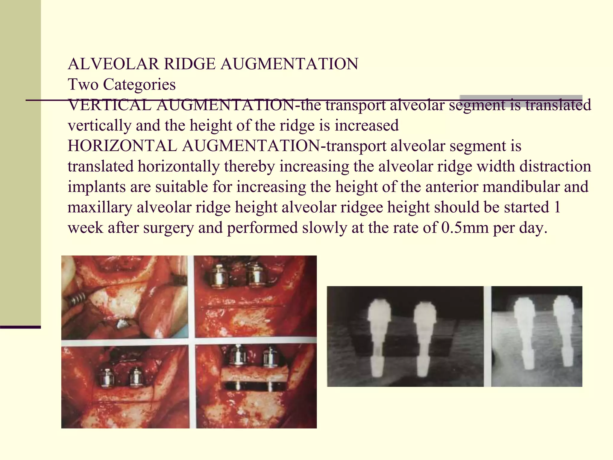 Distraction Osteogenesis | PPT