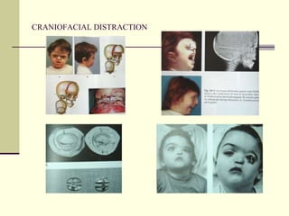 Distraction Osteogenesis | PPT