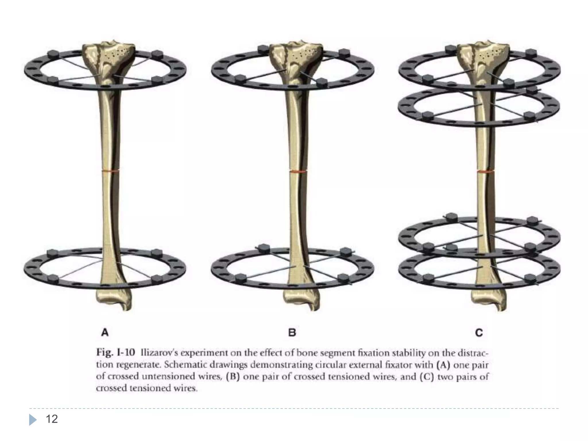 Distraction osteogenesis of craniofacial region | PPTX