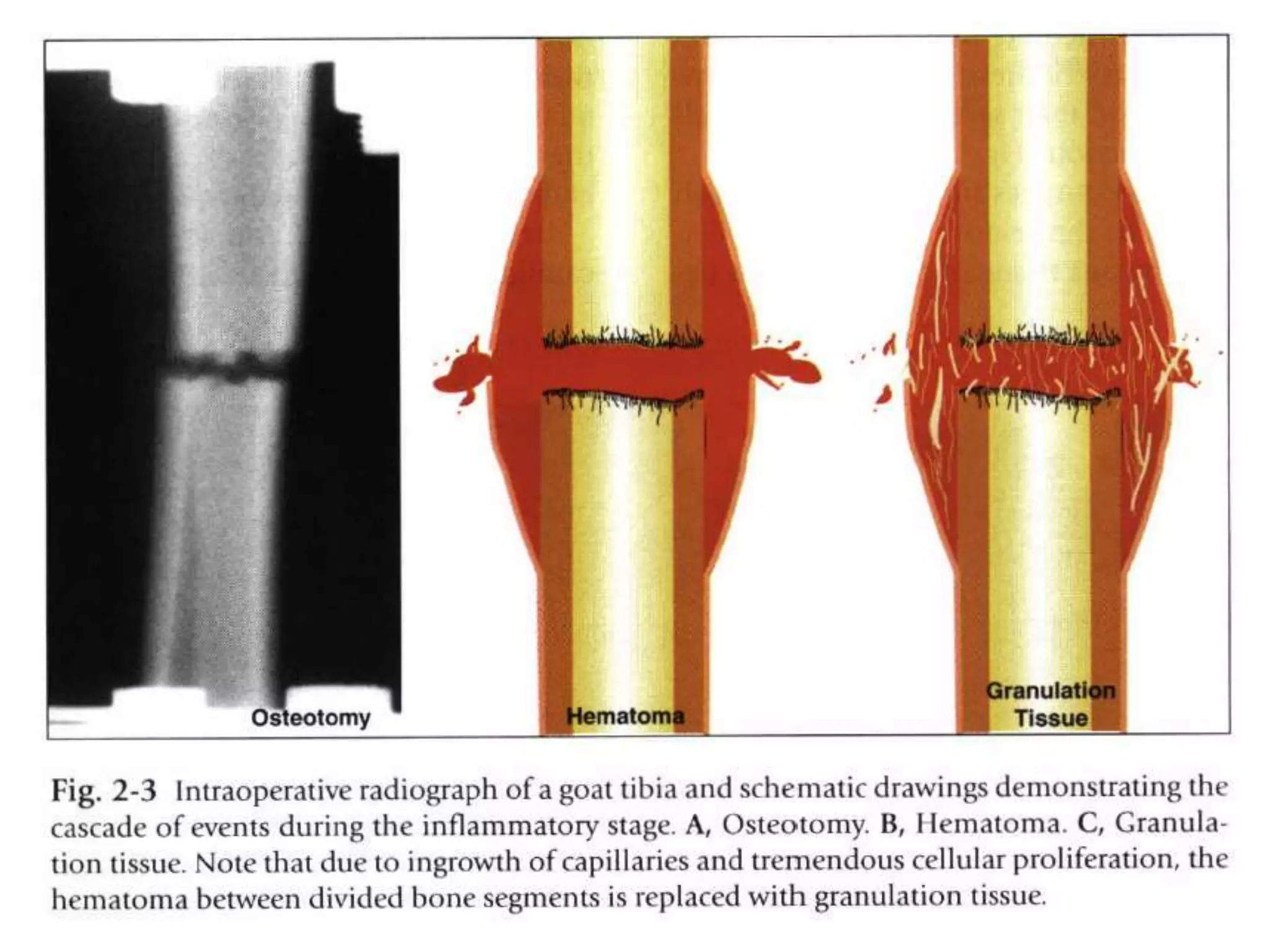 Distraction osteogenesis of craniofacial region | PPTX