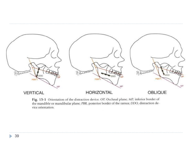 Distraction osteogenesis of craniofacial region | PPTX