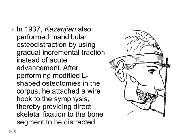 Distraction osteogenesis of craniofacial region | PPTX