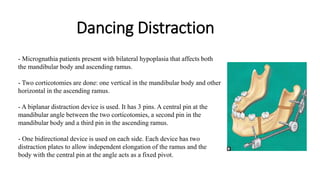 Distraction osteogenesis | PPTX