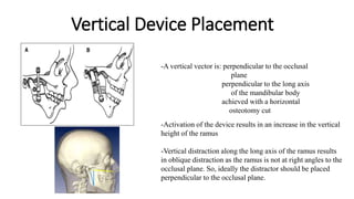 Distraction osteogenesis | PPTX