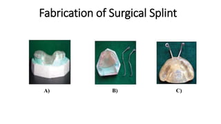 Distraction osteogenesis | PPTX