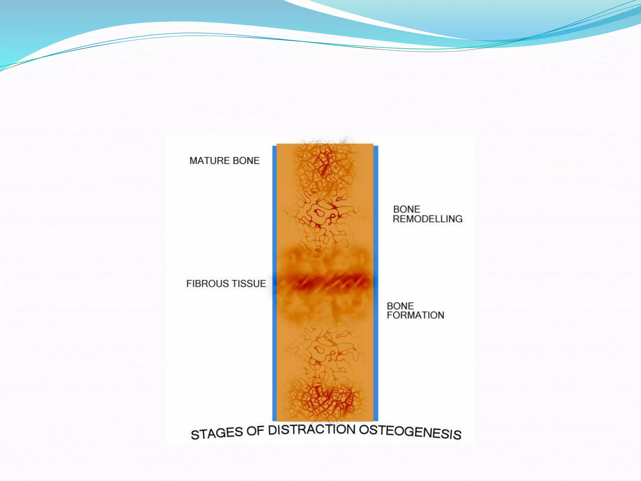 Distraction Osteogenesis.ppt