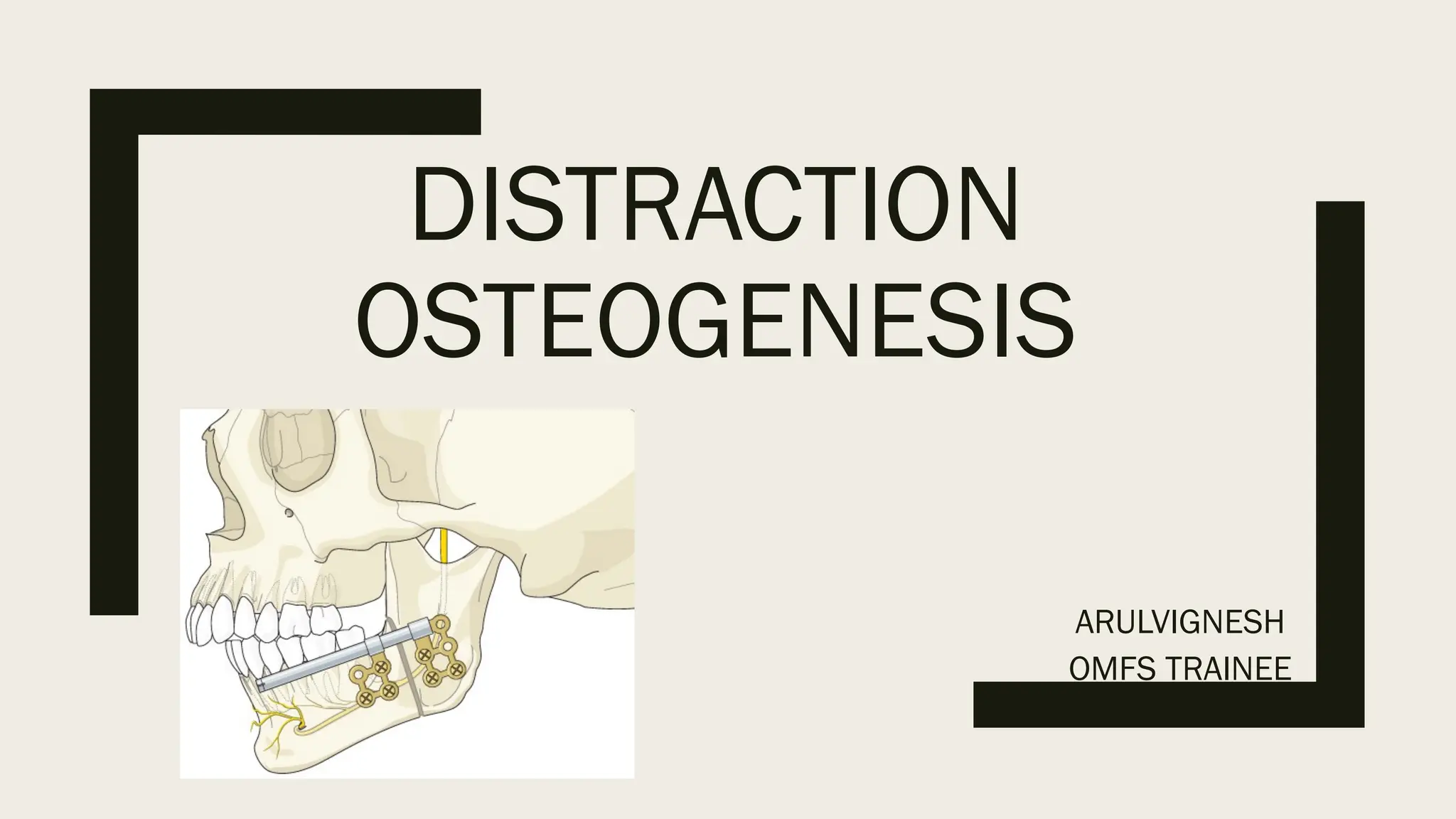 DISTRACTION OSTEOGENESIS OJ JAW OMFS.ppt