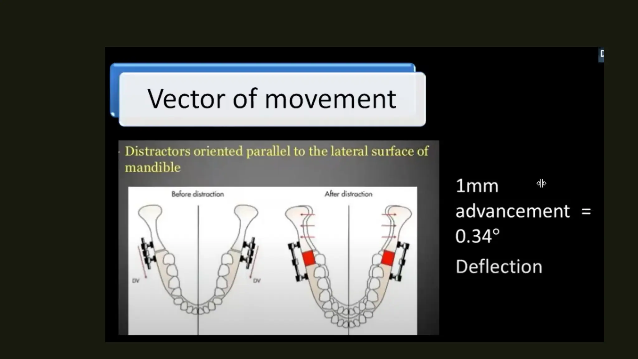 DISTRACTION OSTEOGENESIS OJ JAW OMFS.ppt