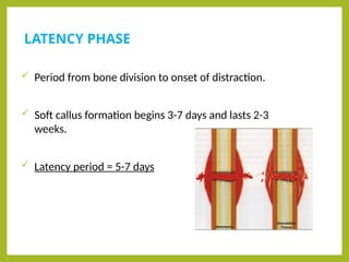 Distraction Osteogenesis.pptx distraction osteogenes | PPTX