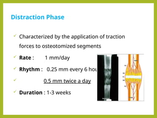 Distraction Osteogenesis.pptx distraction osteogenes | PPTX
