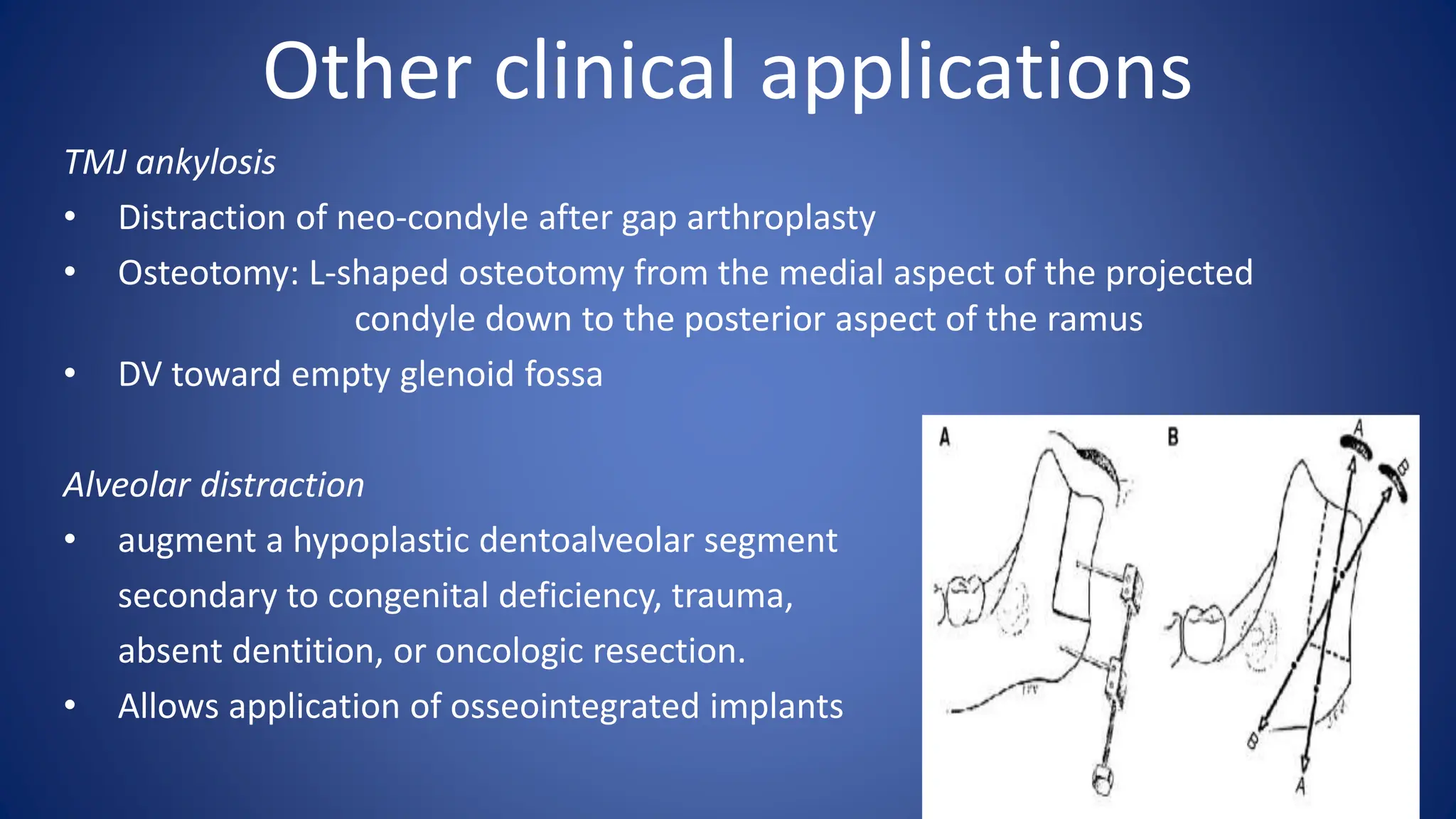 Distraction osteogenesis-Ilizarov AGP.pptx