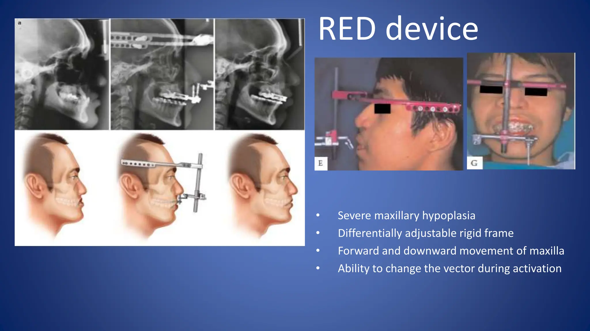 Distraction osteogenesis-Ilizarov AGP.pptx