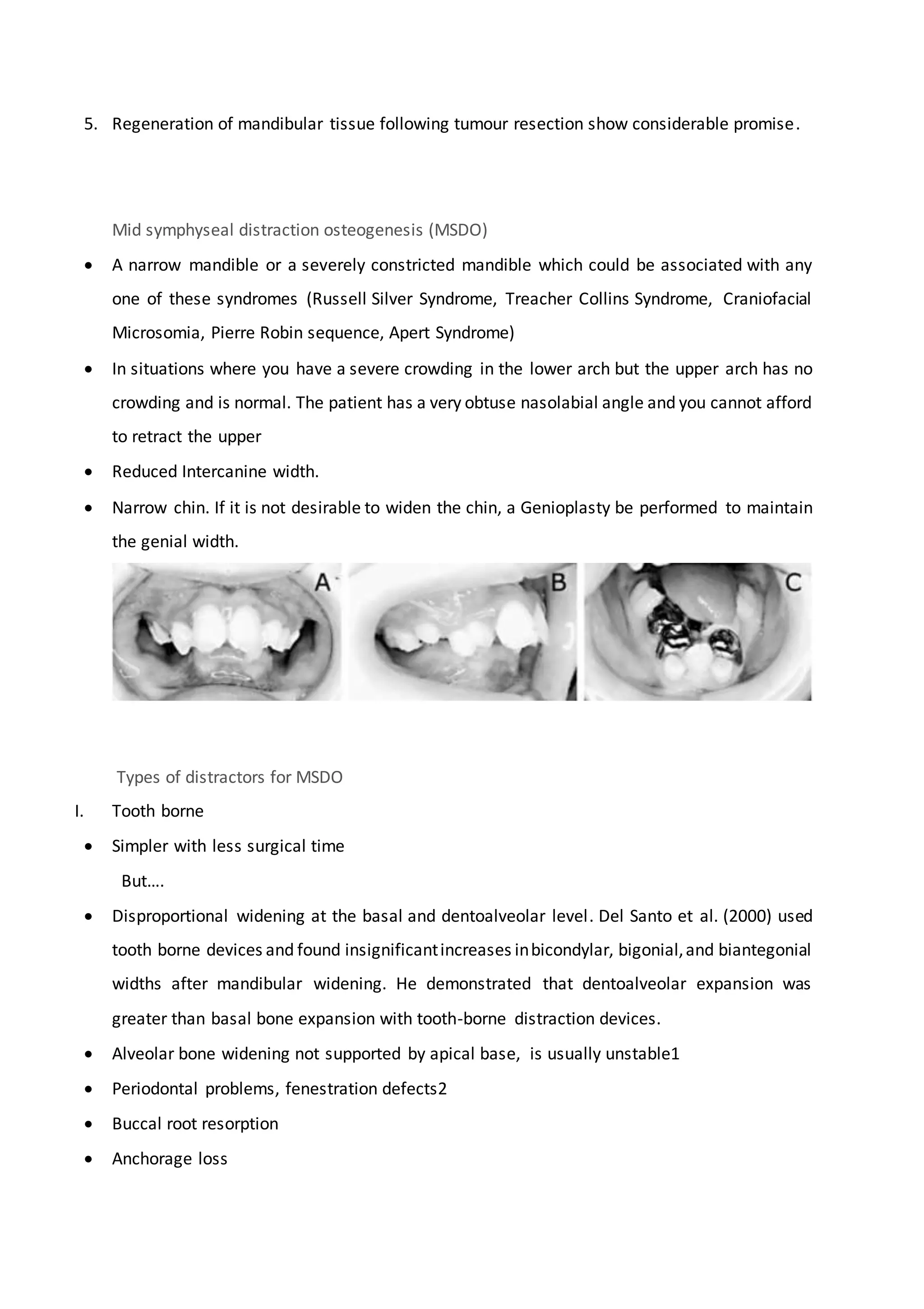 Distraction osteogenesis by Almuzian | DOCX