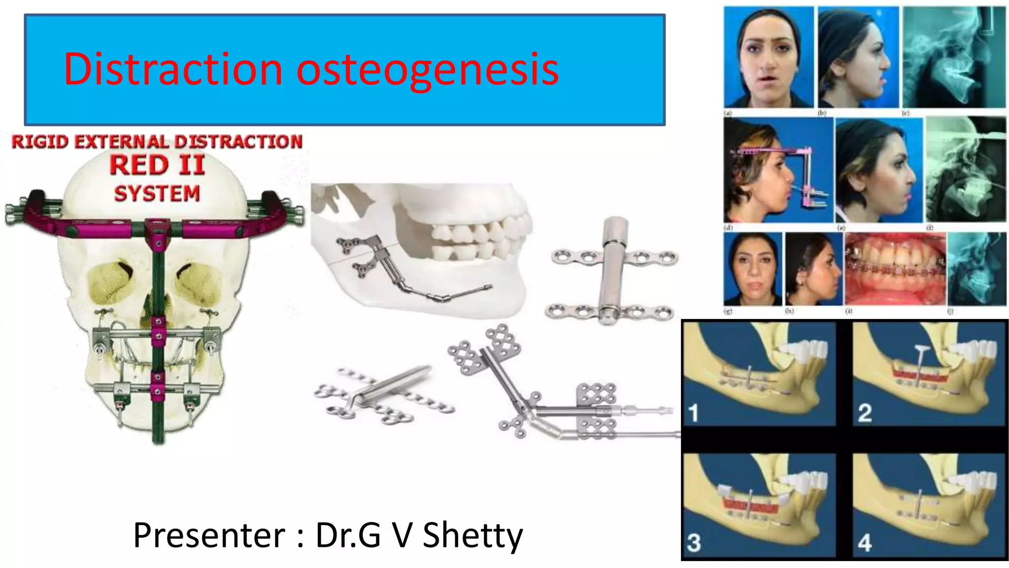 Distraction osteogenesis in orthodontics -Dr.G V SHETTY | PPTX
