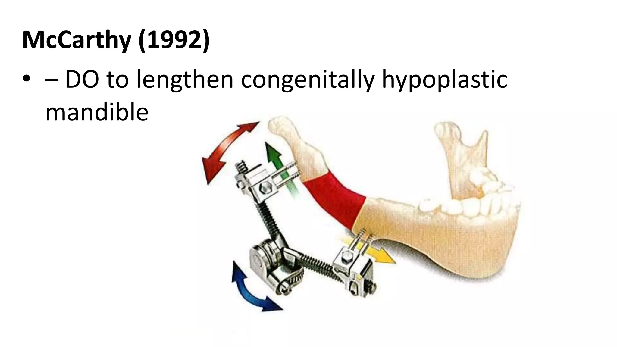 Distraction osteogenesis in orthodontics -Dr.G V SHETTY | PPTX