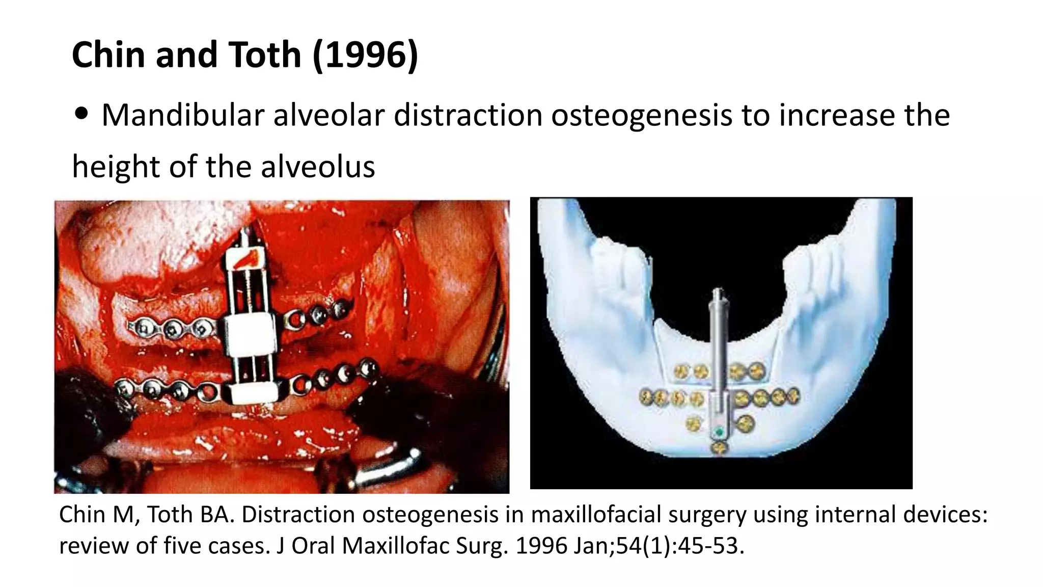 Distraction osteogenesis in orthodontics -Dr.G V SHETTY | PPTX