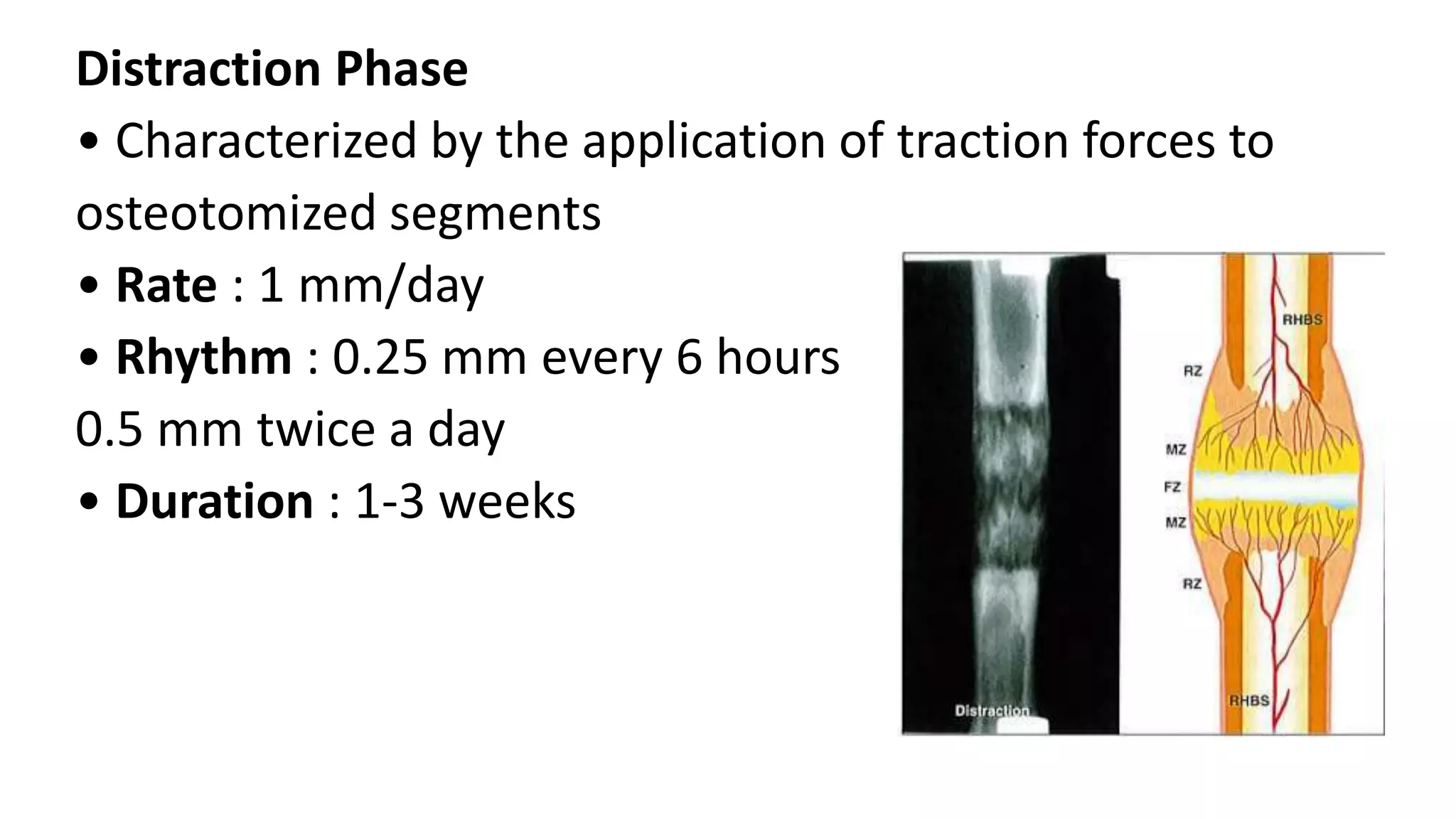 Distraction osteogenesis in orthodontics -Dr.G V SHETTY | PPTX