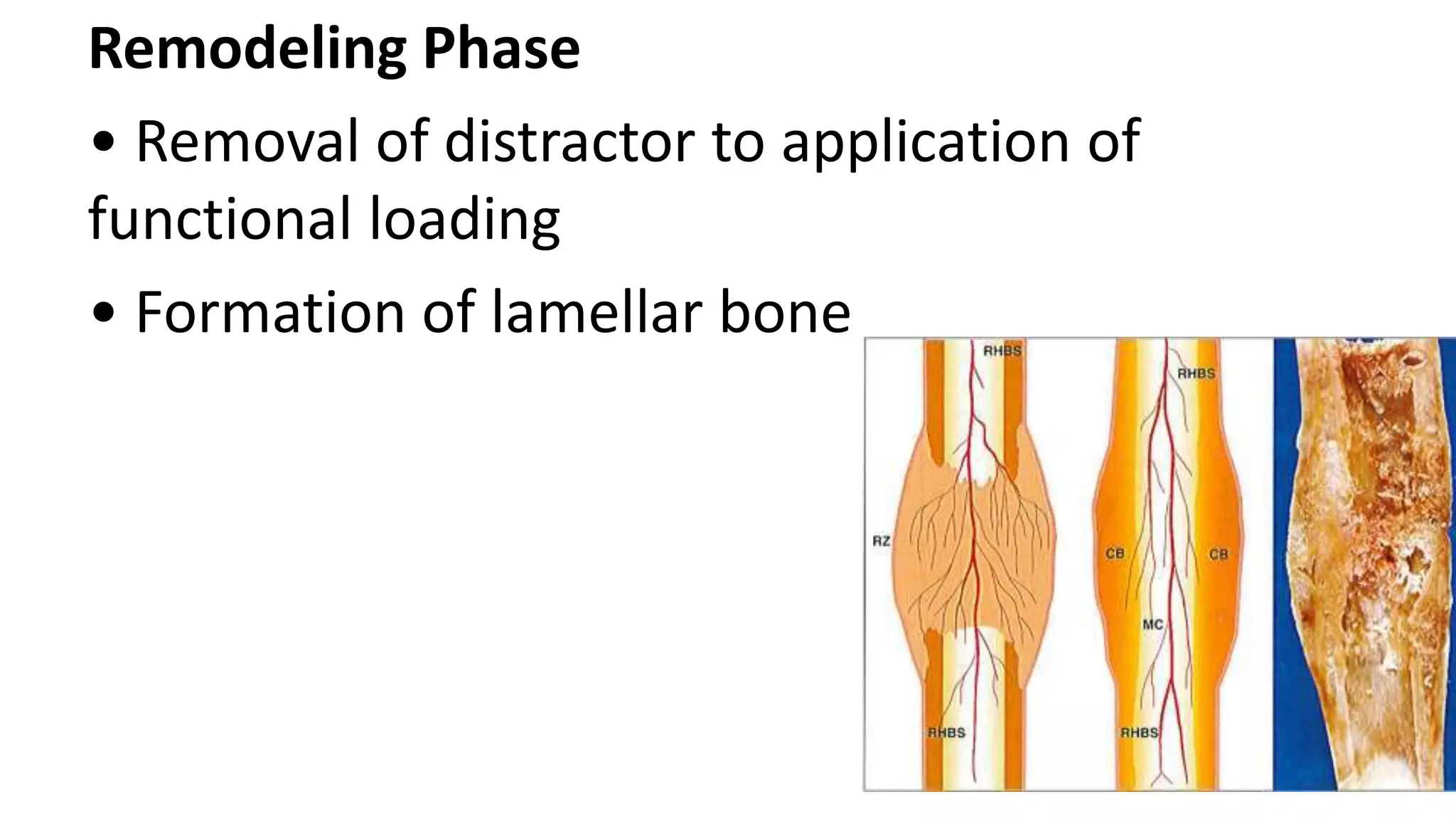 Distraction osteogenesis in orthodontics -Dr.G V SHETTY | PPTX