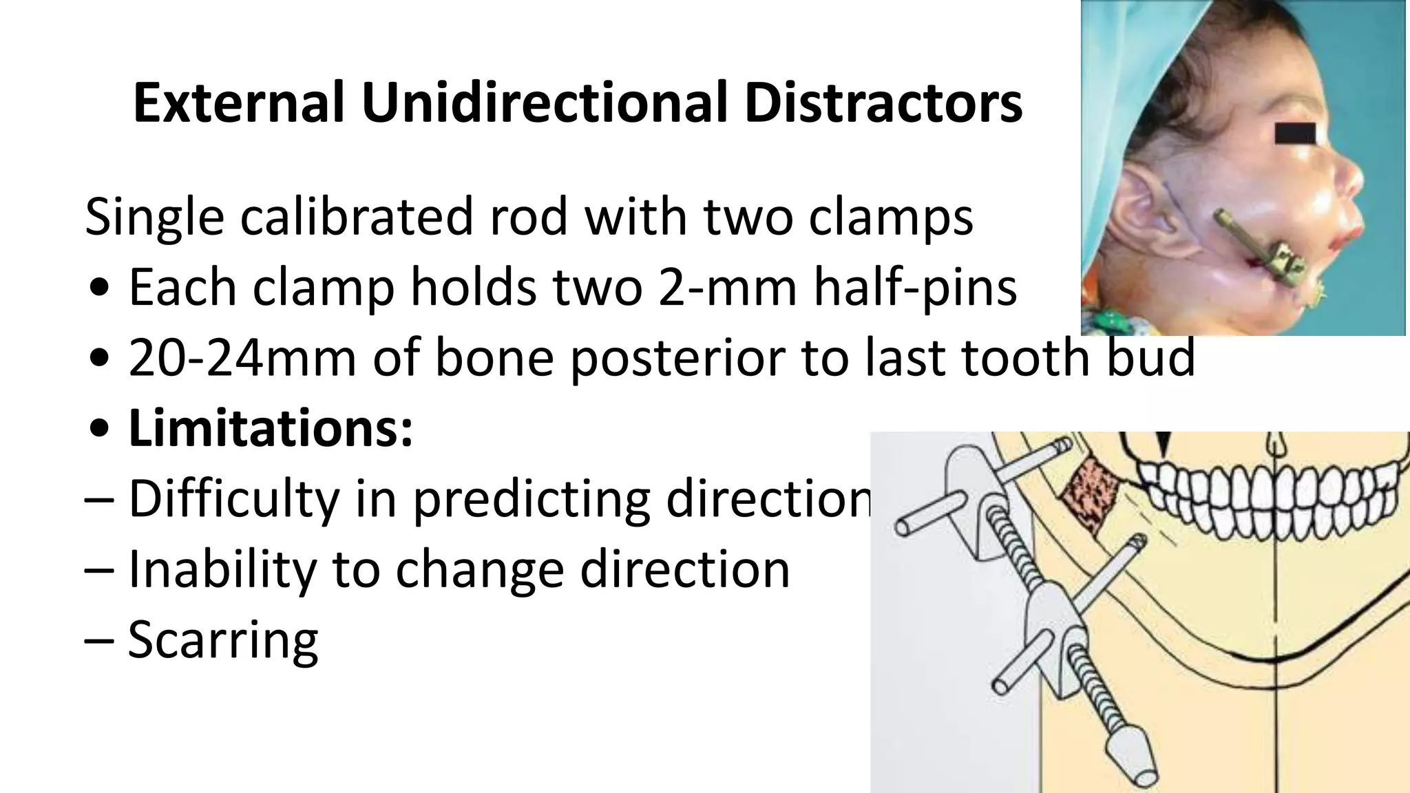 Distraction osteogenesis in orthodontics -Dr.G V SHETTY | PPTX