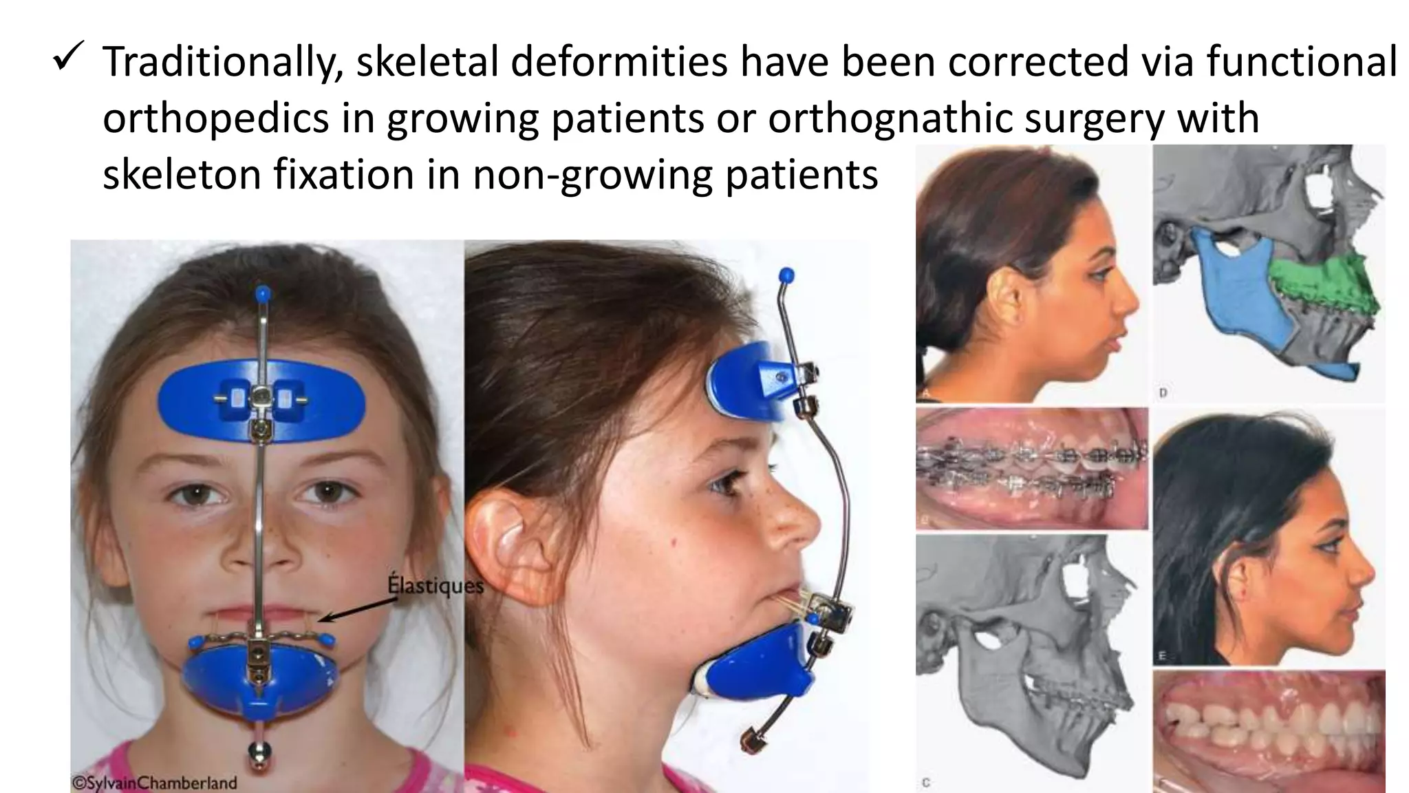 Distraction osteogenesis in orthodontics -Dr.G V SHETTY | PPTX