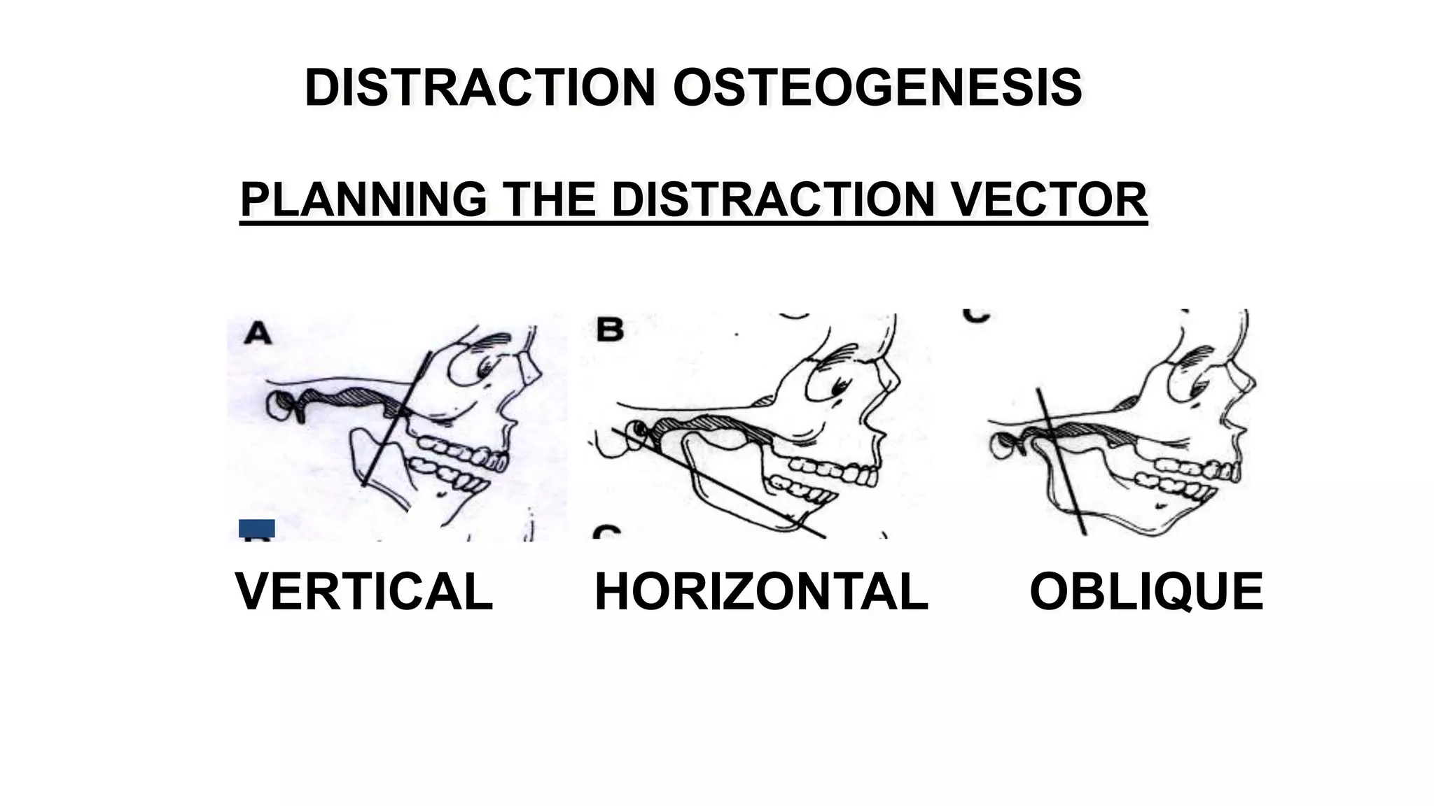 Distraction osteogenesis in orthodontics -Dr.G V SHETTY | PPTX
