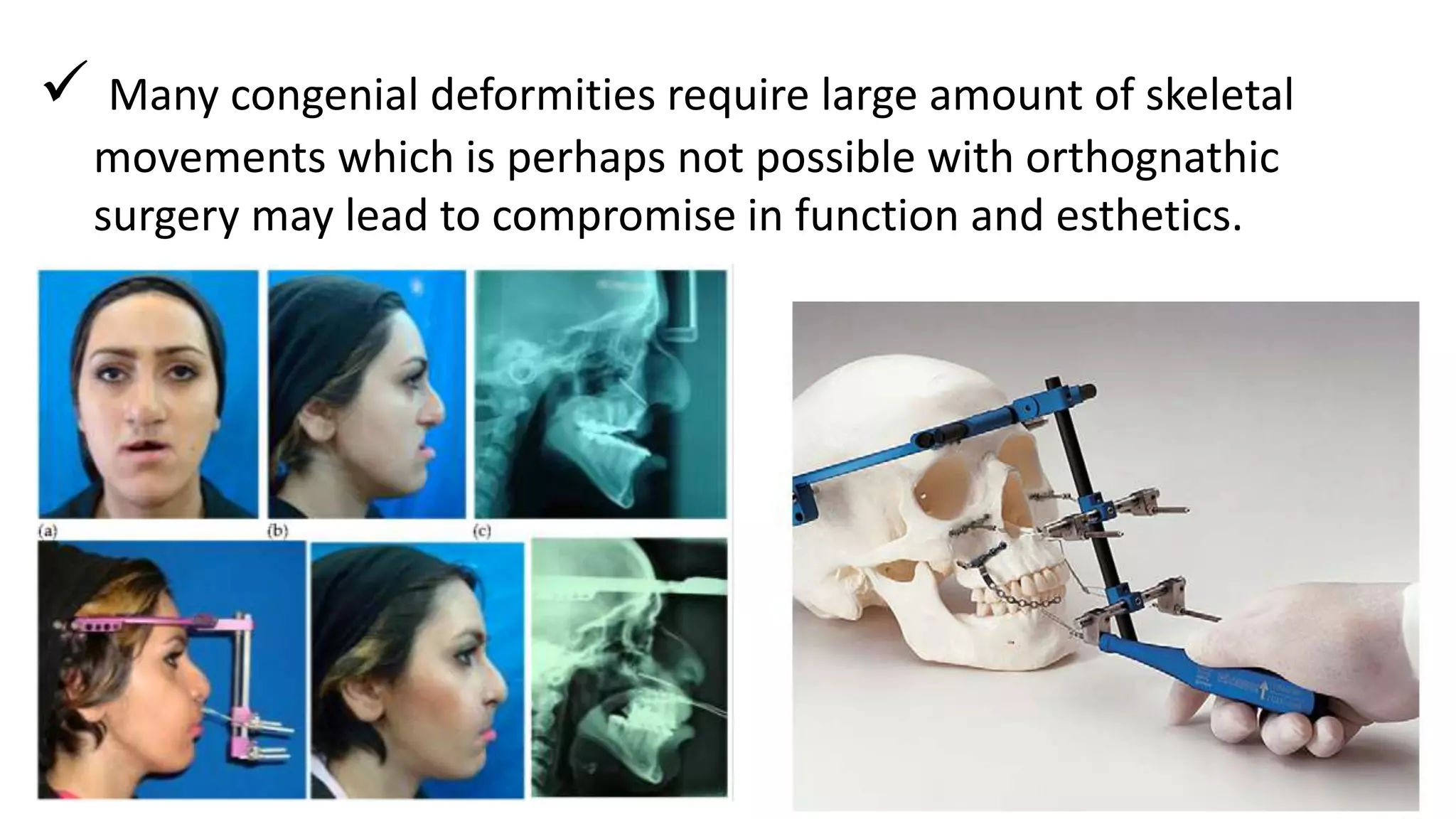 Distraction osteogenesis in orthodontics -Dr.G V SHETTY | PPTX
