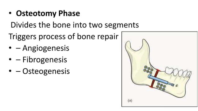 Distraction osteogenesis in orthodontics -Dr.G V SHETTY | PPTX | Bone ...