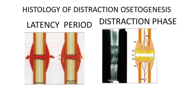 Distraction osteogenesis in orthodontics -Dr.G V SHETTY | PPTX | Bone and Joint Conditions ...
