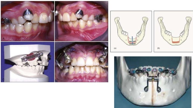 Distraction osteogenesis in orthodontics -Dr.G V SHETTY | PPTX | Bone ...