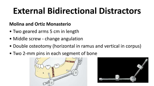 Distraction osteogenesis in orthodontics -Dr.G V SHETTY | PPTX | Bone ...