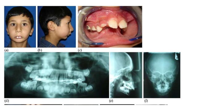 Distraction osteogenesis in orthodontics -Dr.G V SHETTY | PPTX | Bone ...