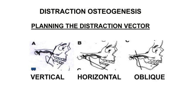 Distraction osteogenesis in orthodontics -Dr.G V SHETTY | PPTX | Bone ...