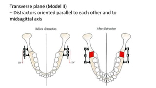 Distraction osteogenesis in orthodontics -Dr.G V SHETTY | PPTX