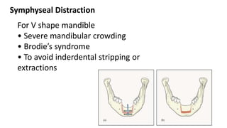 Distraction osteogenesis in orthodontics -Dr.G V SHETTY | PPTX