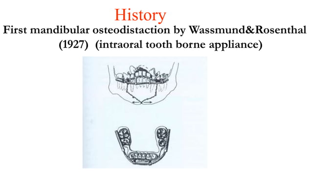 Distraction osteogenesis in orthodontics -Dr.G V SHETTY | PPTX | Bone ...