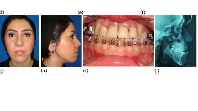 Distraction Osteogenesis In Orthodontics Dr G V Shetty