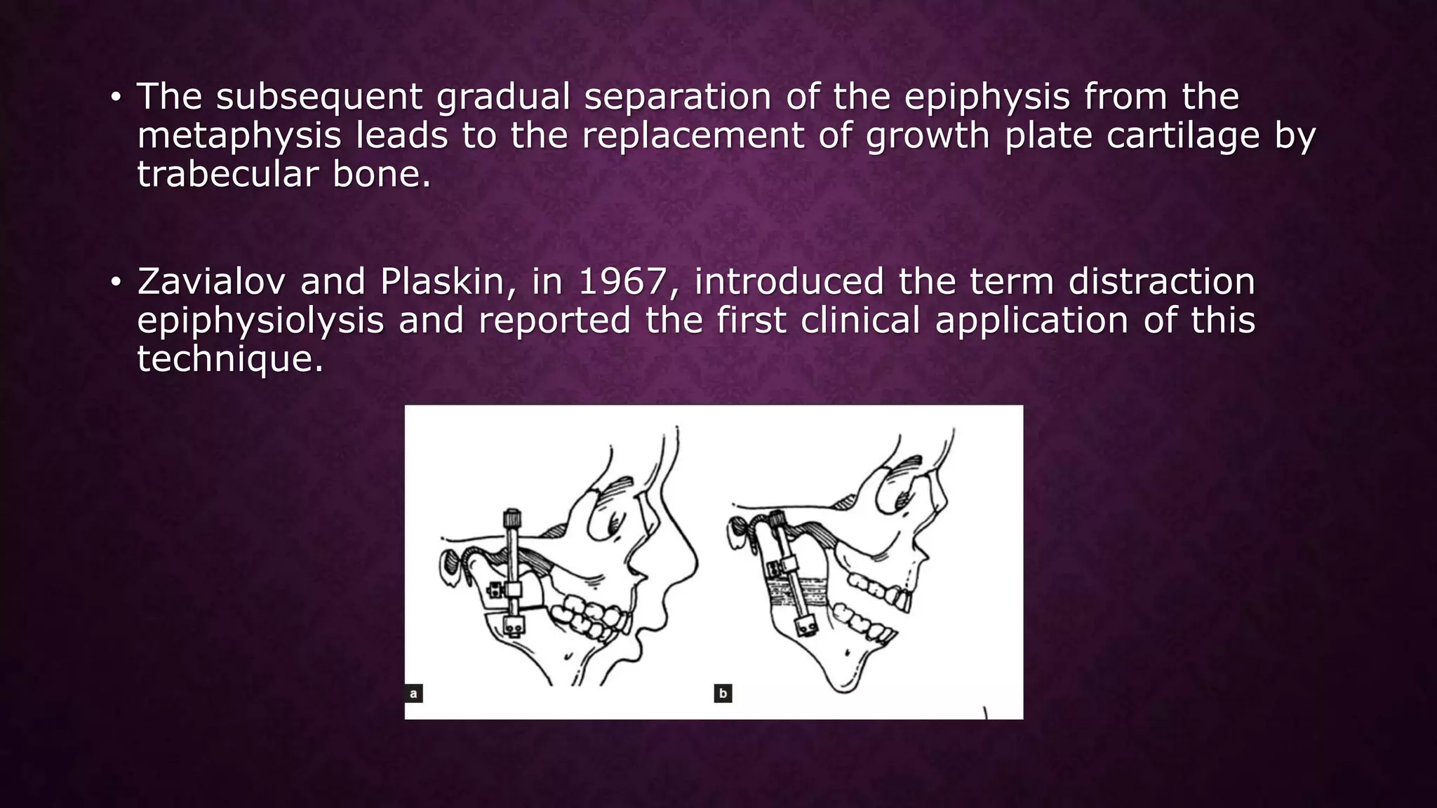 Distraction osteogenesis in maxillofacial surgery | PPTX