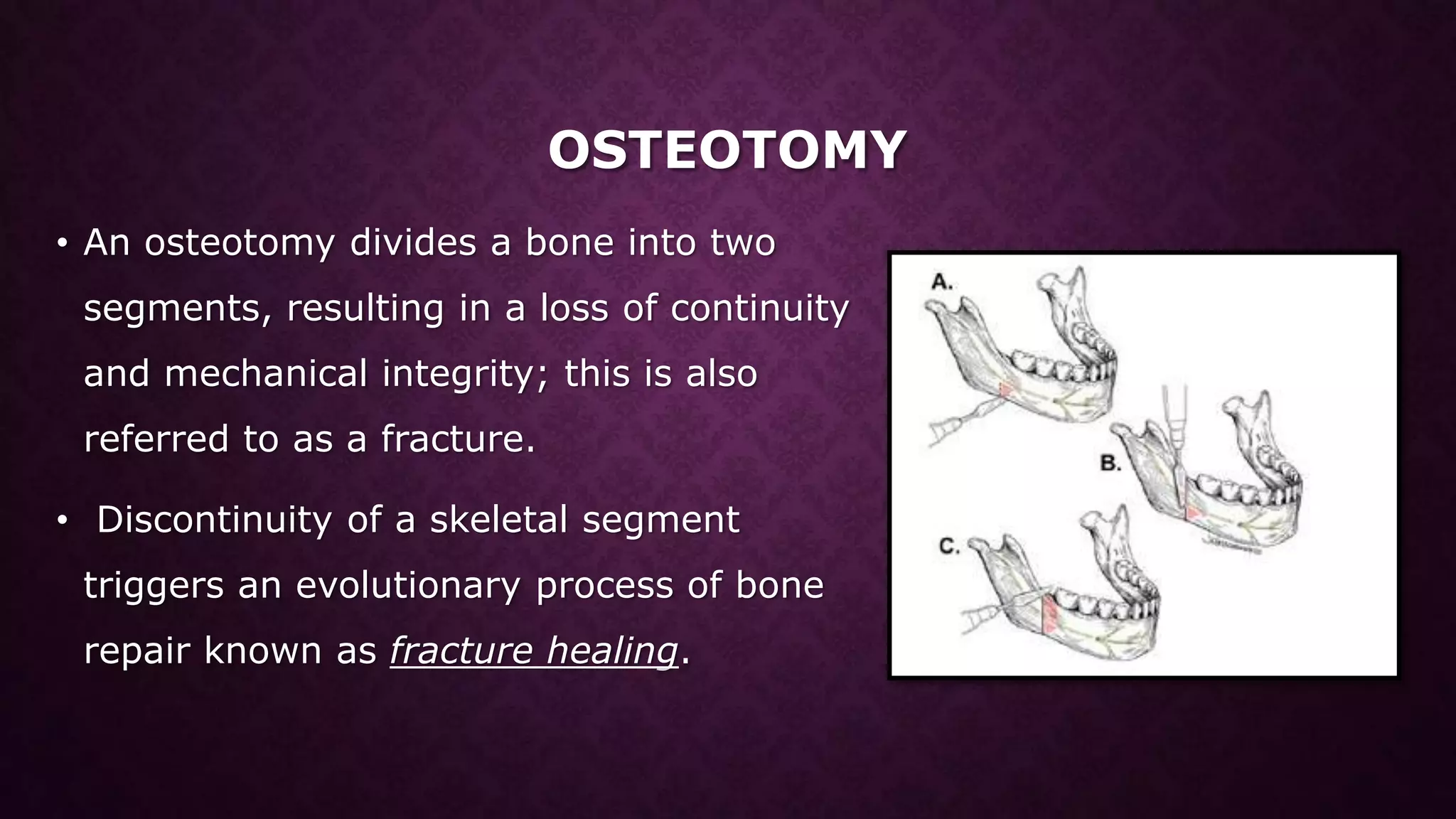 Distraction osteogenesis in maxillofacial surgery | PPTX
