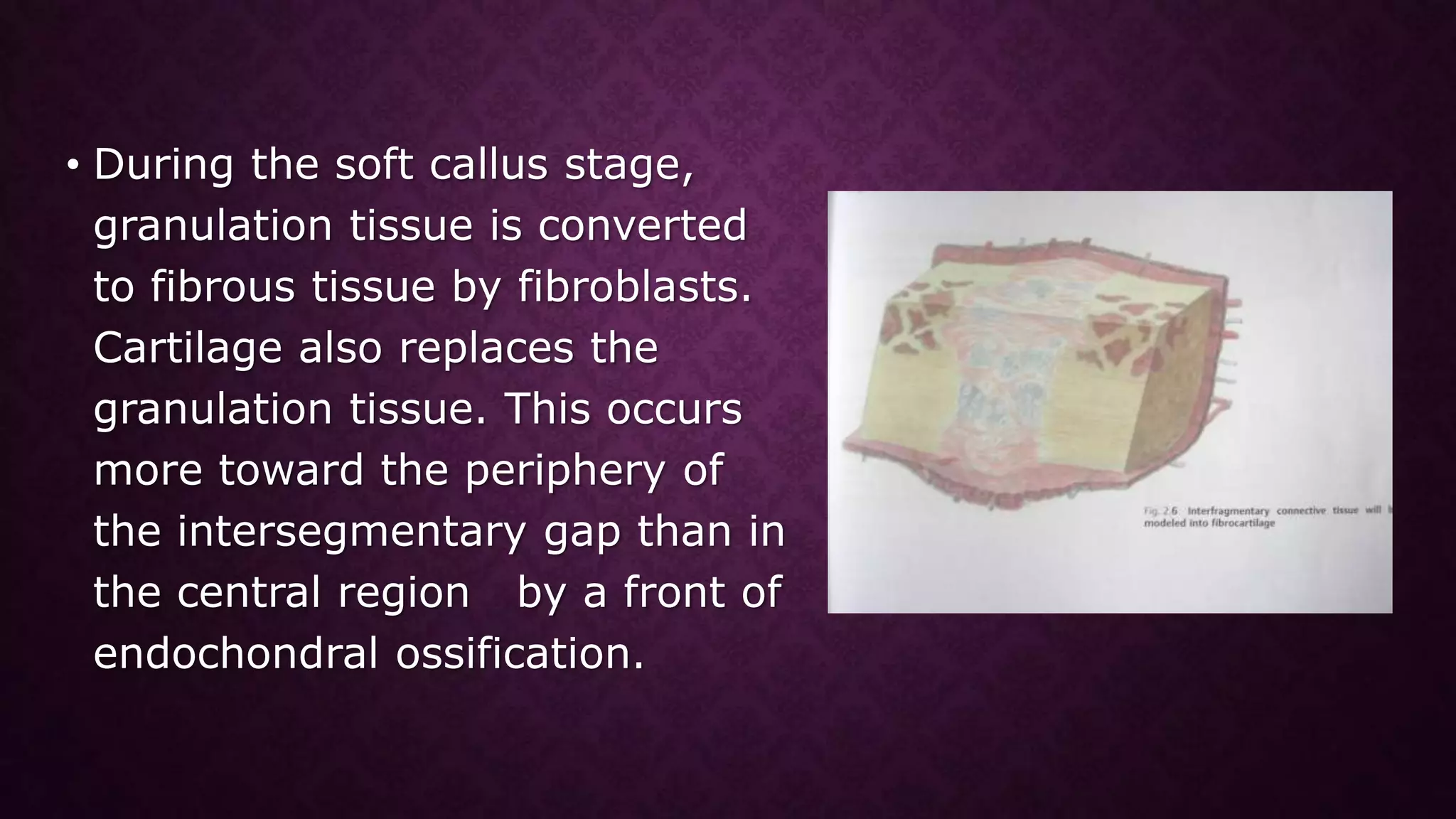 Distraction osteogenesis in maxillofacial surgery | PPTX