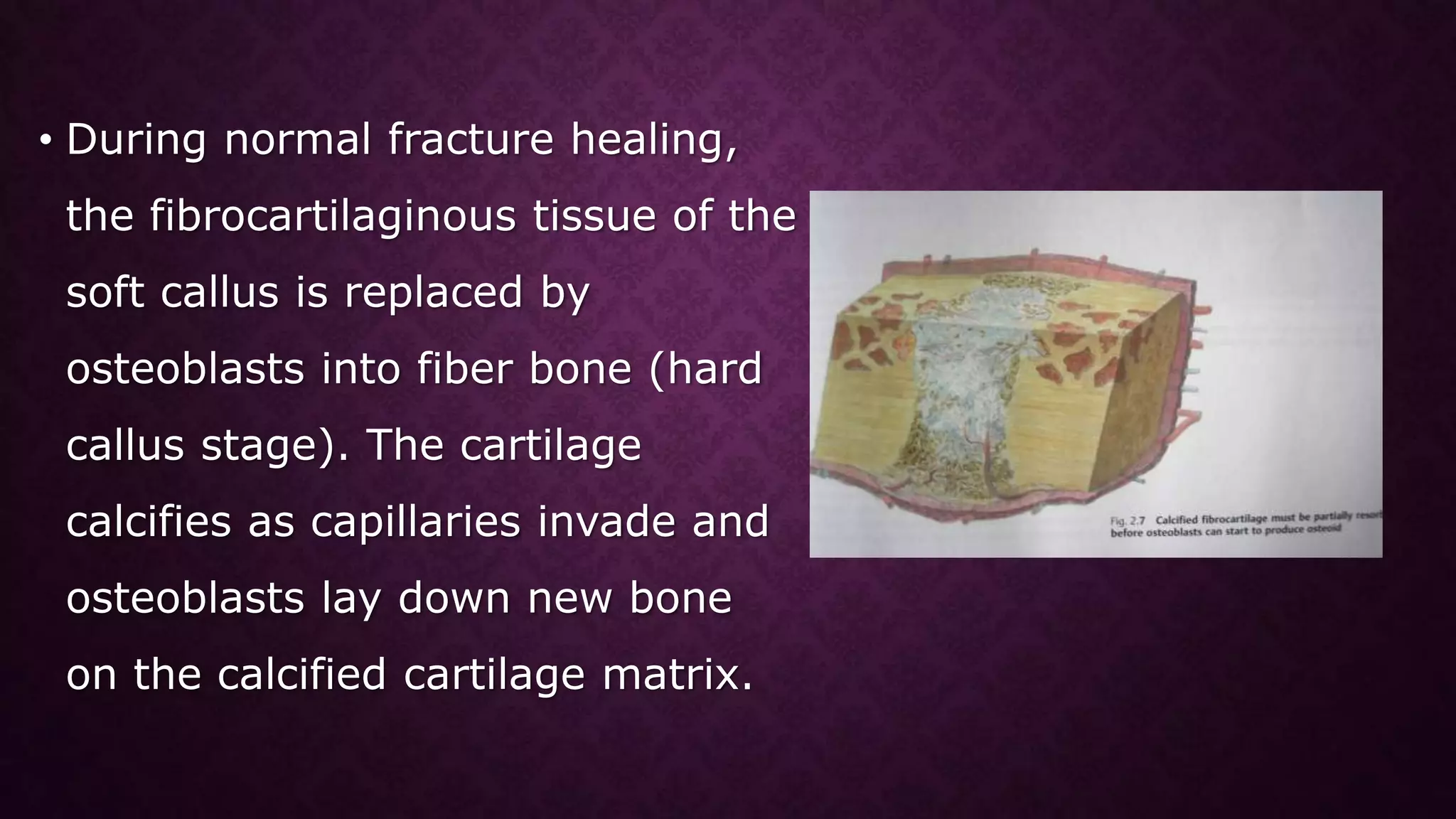 Distraction osteogenesis in maxillofacial surgery | PPTX