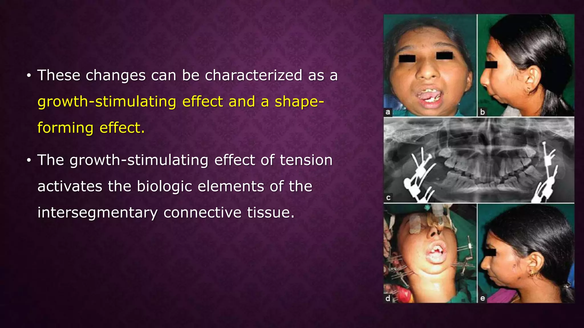 Distraction osteogenesis in maxillofacial surgery | PPTX