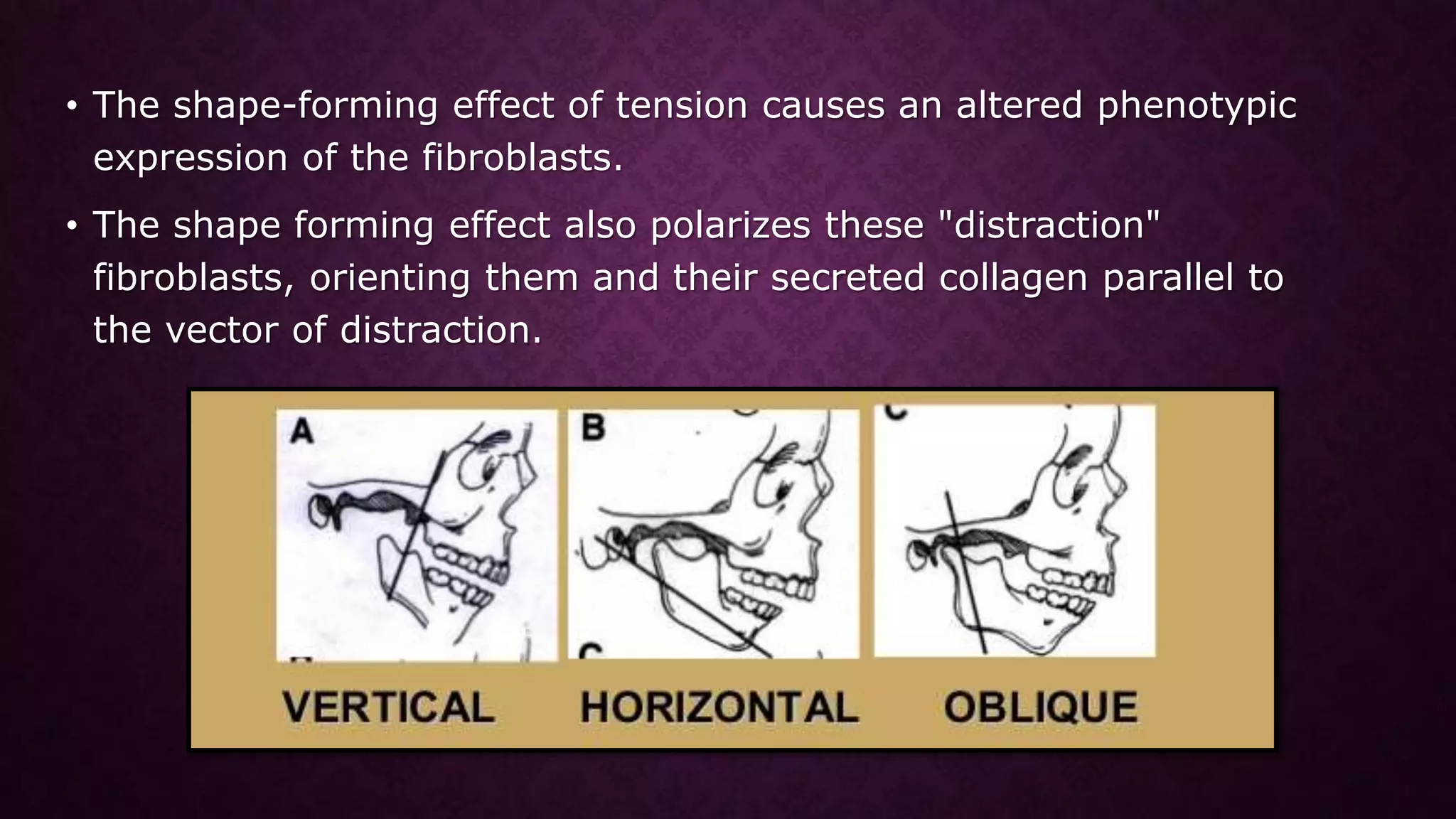 Distraction osteogenesis in maxillofacial surgery | PPTX