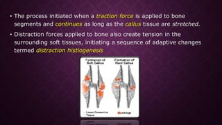 Distraction osteogenesis in maxillofacial surgery | PPTX
