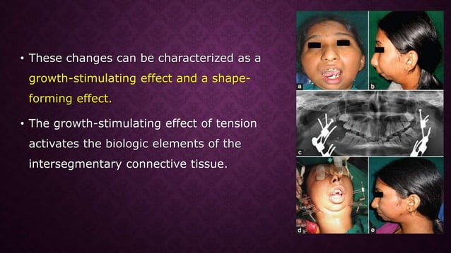 Distraction osteogenesis in maxillofacial surgery | PPTX
