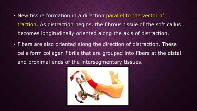 Distraction osteogenesis in maxillofacial surgery | PPTX