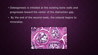 Distraction osteogenesis in maxillofacial surgery | PPTX