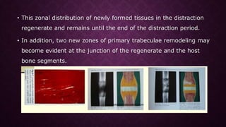 Distraction osteogenesis in maxillofacial surgery | PPTX