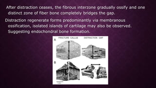 Distraction osteogenesis in maxillofacial surgery | PPTX
