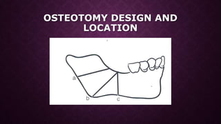 Distraction osteogenesis in maxillofacial surgery | PPTX