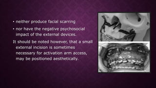 Distraction osteogenesis in maxillofacial surgery | PPTX